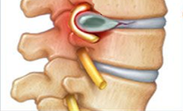 Disk Injury treatment at Injury-Care Center