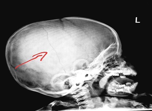 Headache after Car Accident - Injury-Care Center